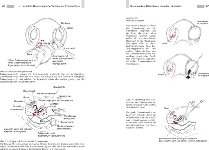 Diametric Endometriose - Die verkannte Frauenkrankheit - Galaxus