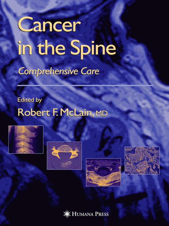 Springer Cancer in the Spine - kaufen bei Galaxus